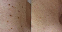 NadaDerm Original Mole & Skin Tag Remover Cream, Original Formula ...