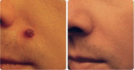 NadaDerm Original Mole & Skin Tag Remover Cream, Original Formula ...