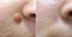 NadaDerm Original Mole & Skin Tag Remover Cream, Original Formula ...