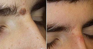 NadaDerm Original Mole & Skin Tag Remover Cream, Original Formula ...