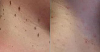 Mole & Skin Tag Remover Cream, NadaDerm Elite, New Overnight Formula ...